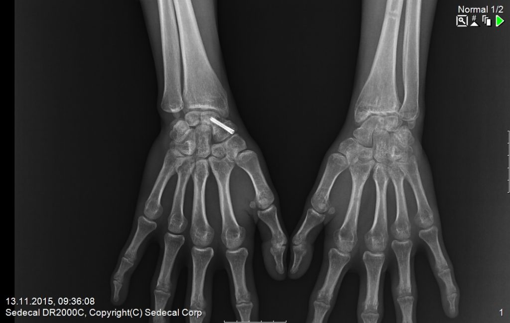 El bilek skafoid kemik kırığı – Prof. Dr. Levent Altınel | Antalya ...