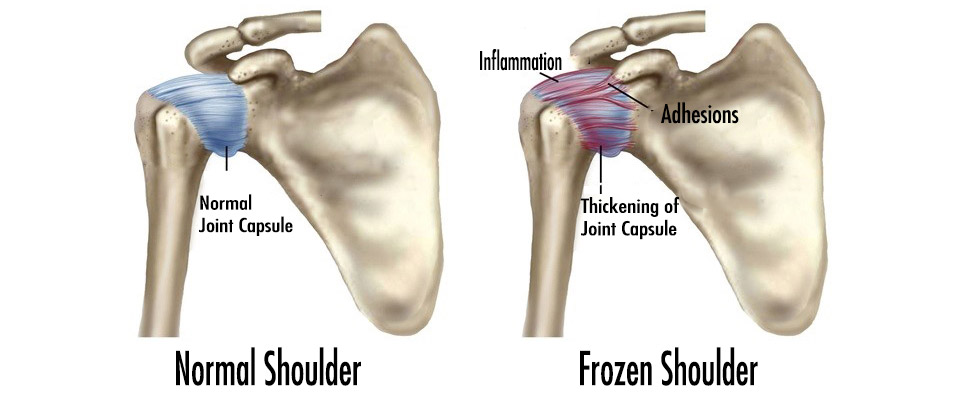 WHAT IS FROZEN SHOULDER SYNDROME? – Prof. Dr. Levent Altınel | Antalya ...