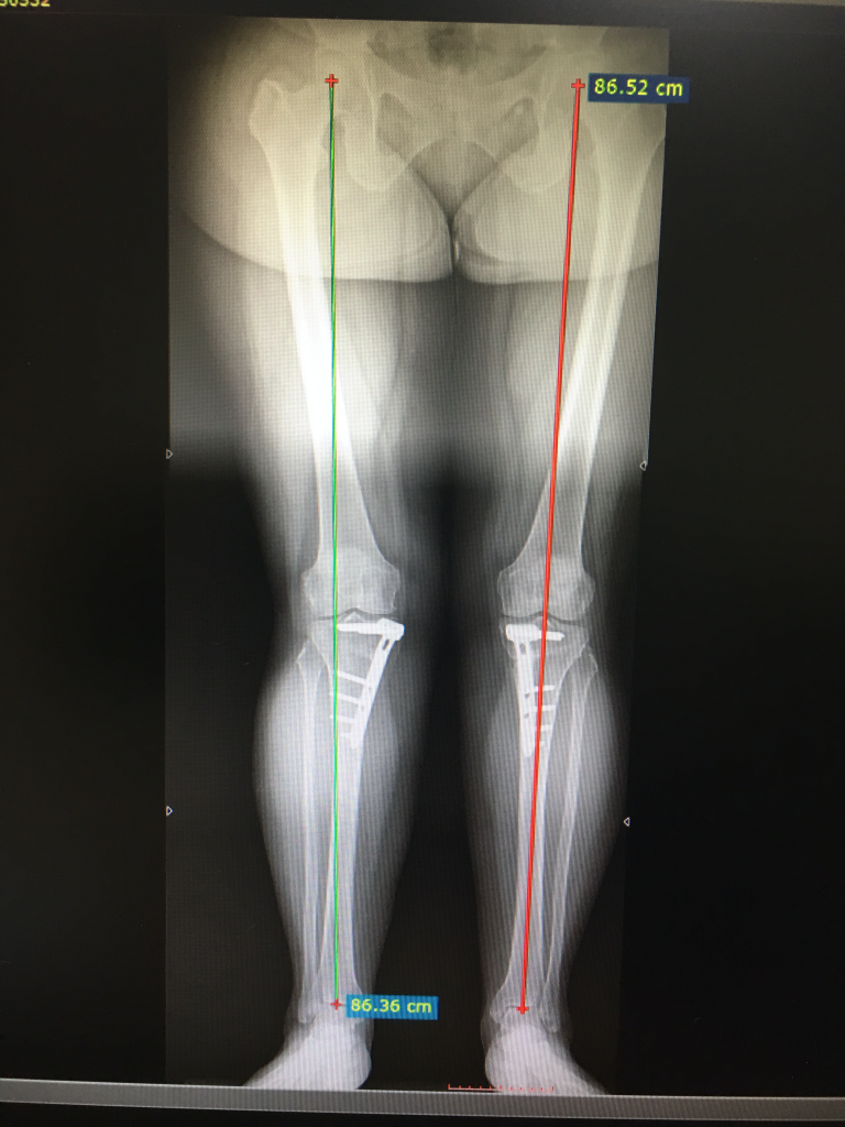 Correction of Leg Curvature (High Tibia Osteotomy) – Prof. Dr. Levent ...